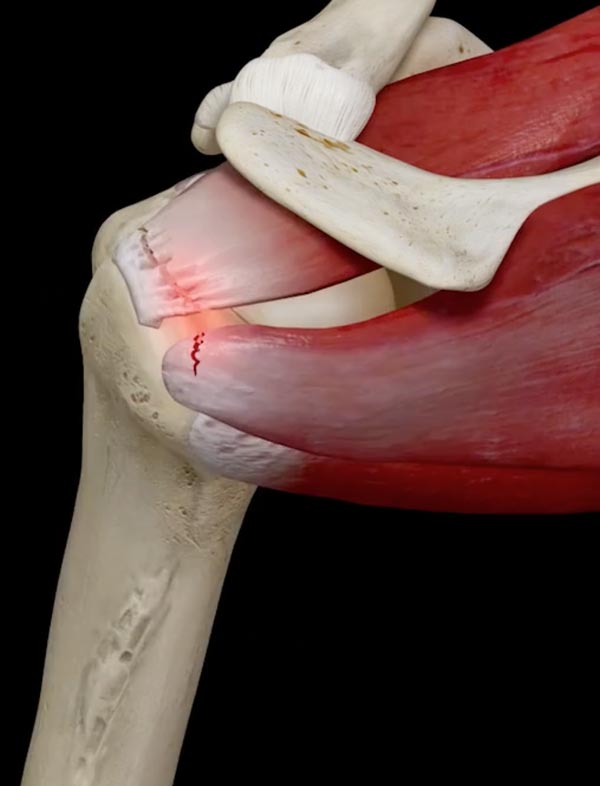 Exercise for Shoulder Pain Relief and Strength - DSNC Sports Performance